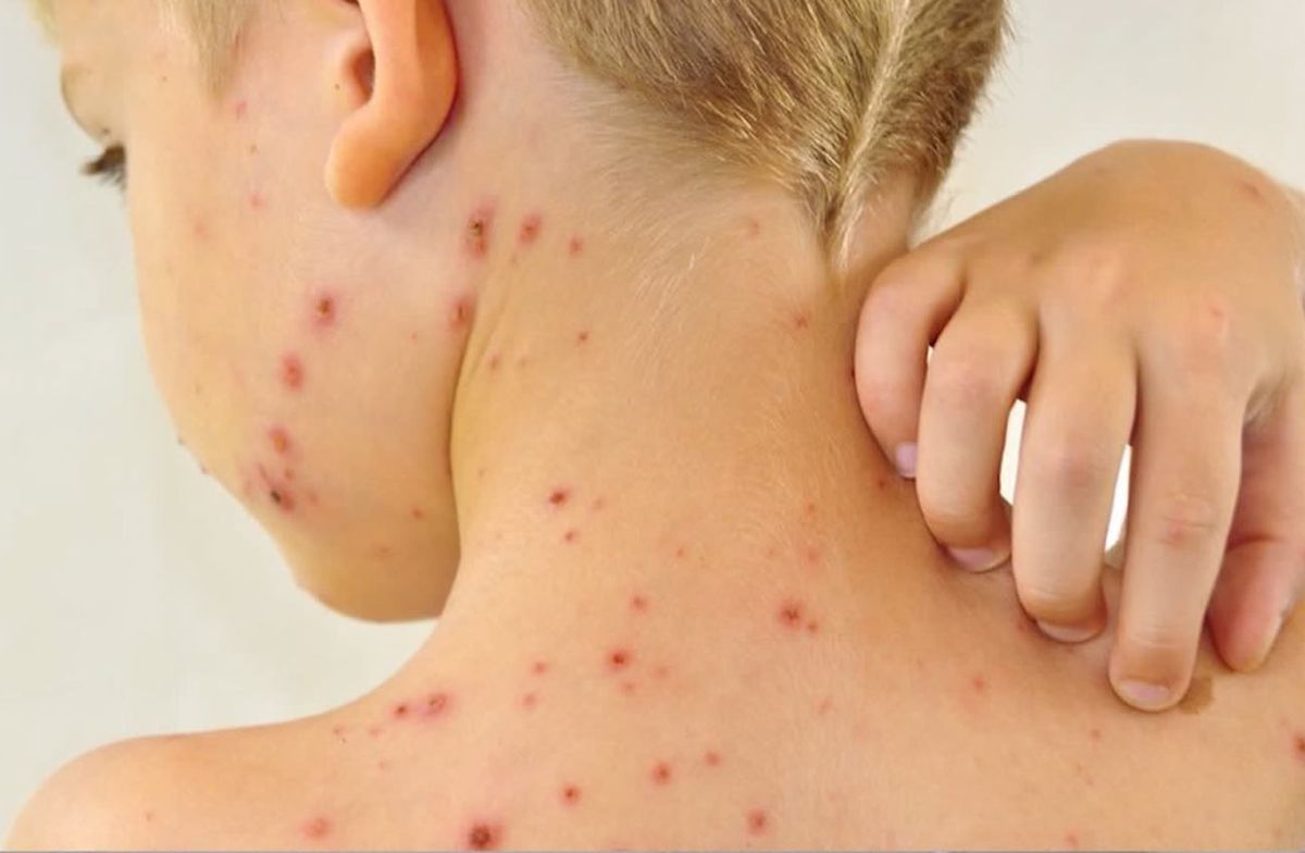 Estreptococo En La Cara